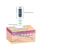 Peripheral Nerve Stimulation: A New Tool In The Battle Against Chronic ...