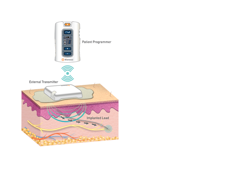 Peripheral Nerve Stimulation: A New Tool In The Battle Against Chronic ...